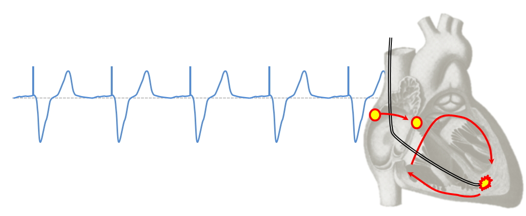 Single and dual chamber pacing modes | Deranged Physiology