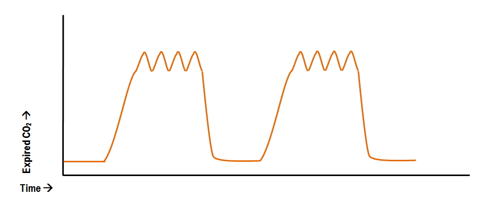 Abnormal capnography waveforms and their interpretation | Deranged ...