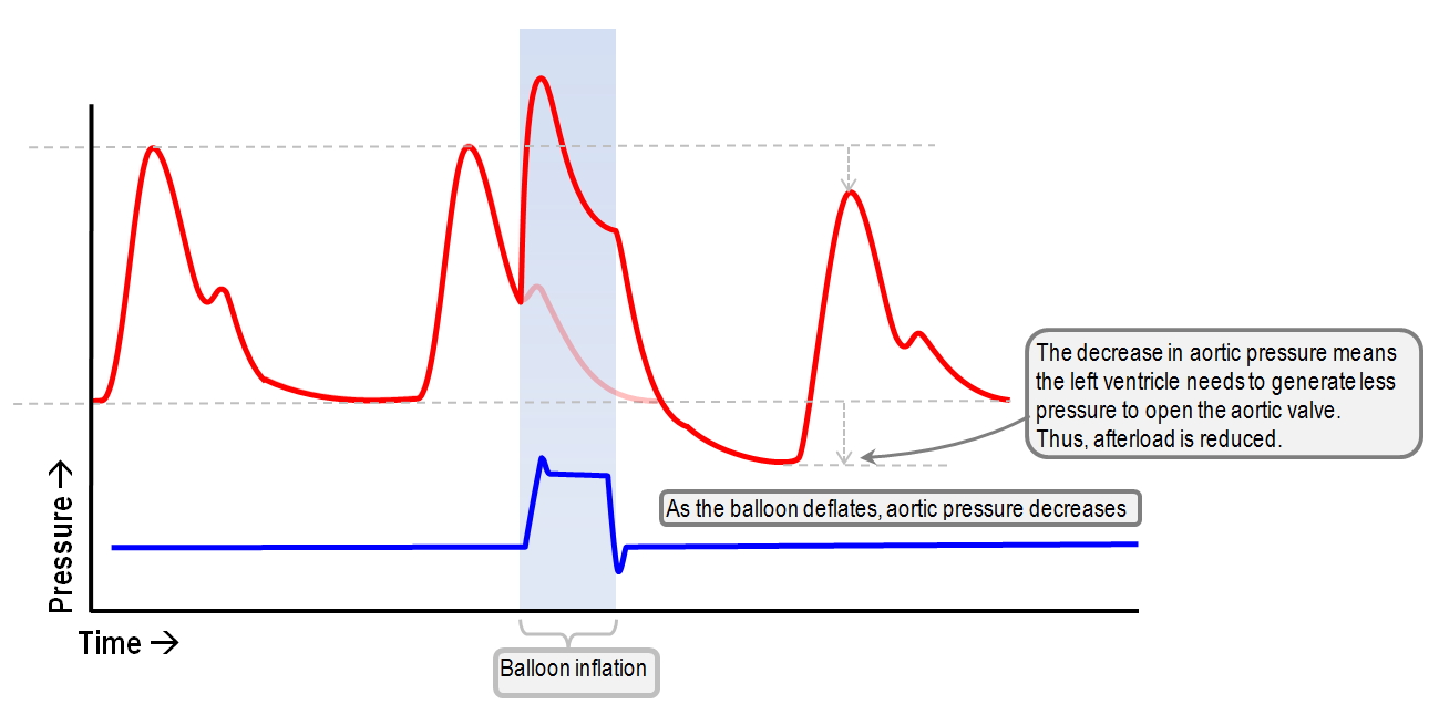 Benefits of an IABP-assisted decrease in aortic pressure | Deranged ...