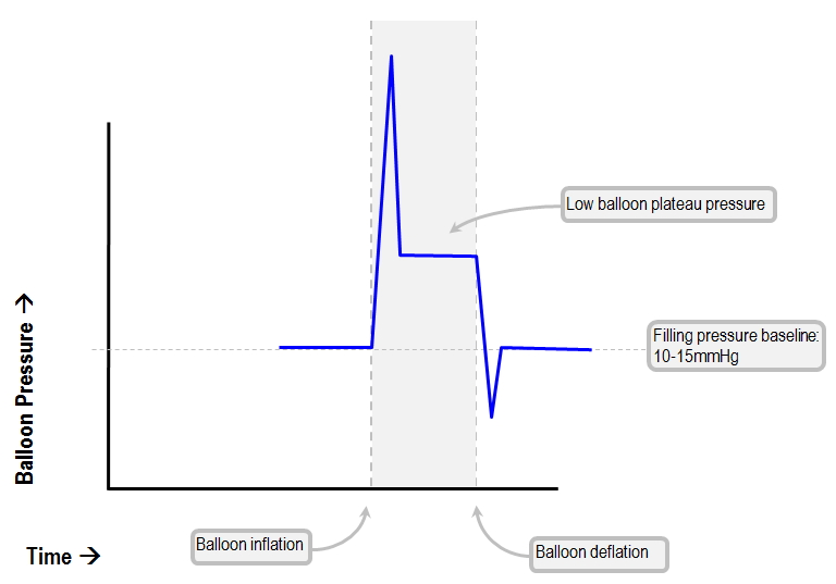 Abnormal IABP balloon pressure waveforms | Deranged Physiology