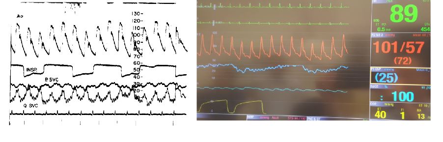 Cardiac tamponade | Deranged Physiology
